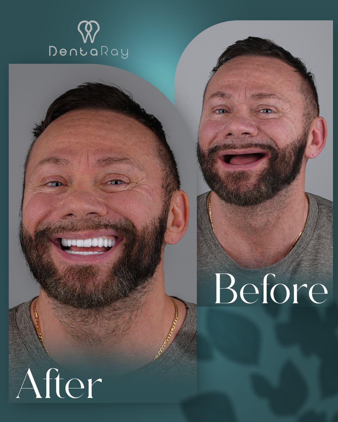 Permanent Full Arch Restoration | Full Mouth Dental Implants & All on 4 ...